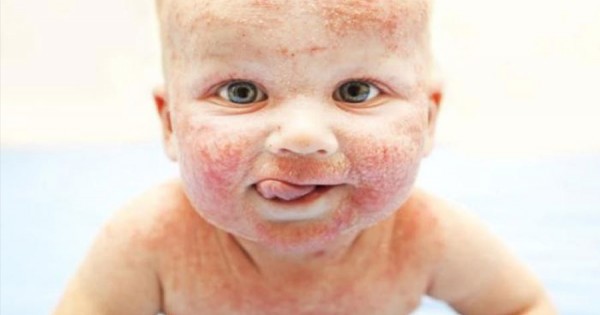 Atopijski dermatitis | online apoteka